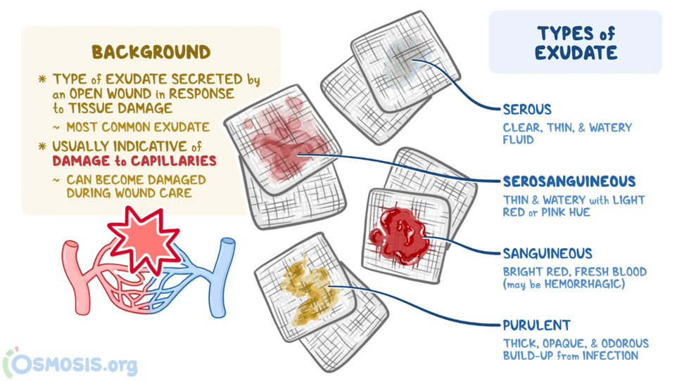 hemorrhagic exudate example