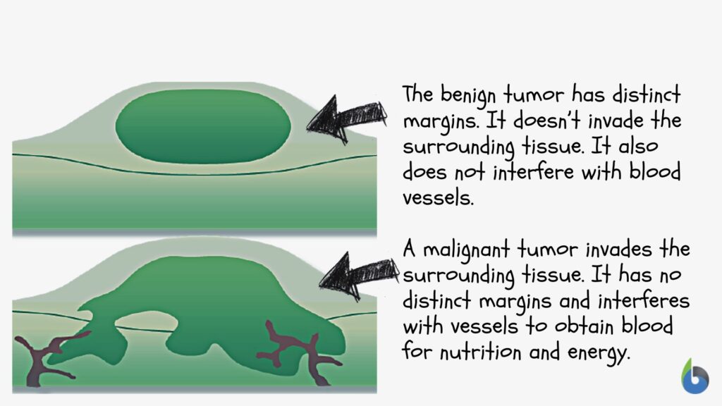 Benign Tumor Diagram Colon Polyp Size And Type Charts