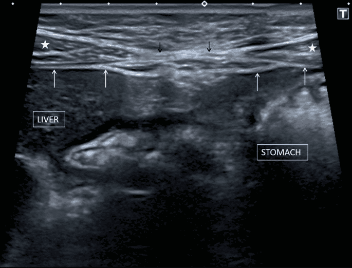 Peritoneum - Definition and Examples - Biology Online Dictionary