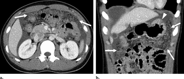 Peritoneum - Definition and Examples - Biology Online Dictionary